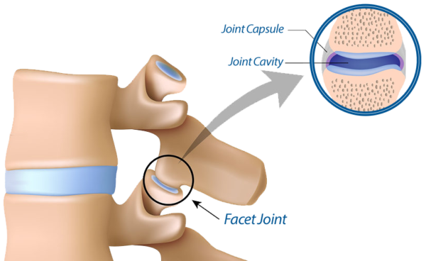 Facet Disease or Facet Syndrome - Dr. Abhijit Pawar